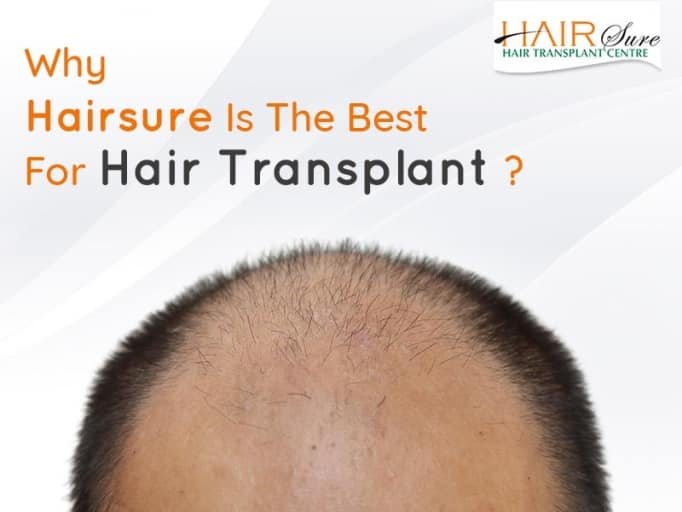 Why Hairsure Is The Best For A Hair Transplant Cyber Hairsure