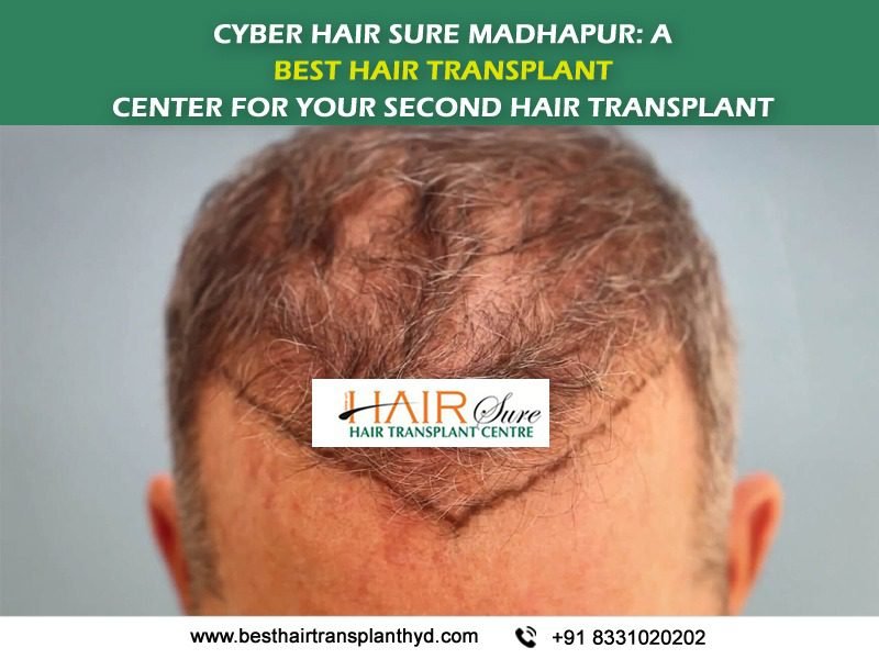 Cyber Hair Sure Madhapur A Best Hair Transplant Center For Your Second